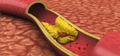 fig3-placas de ateroma - Urólogo especialista en Málaga. Dr. J. Ángel ...
