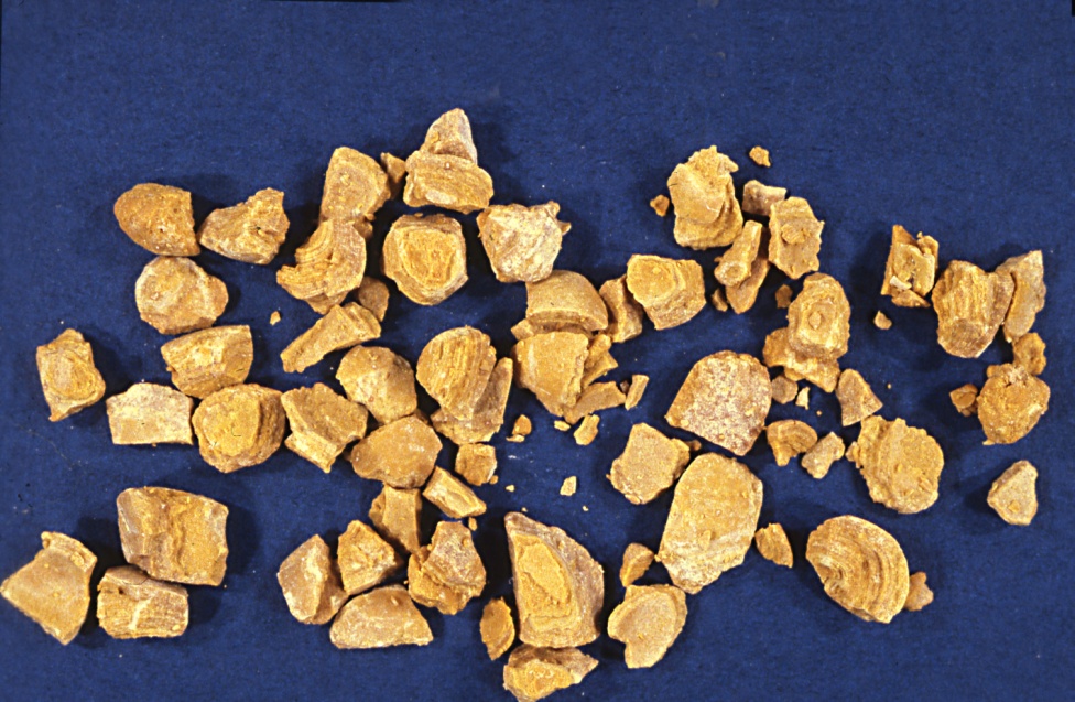 Litiasis | Piedras | Calculos renales Málaga