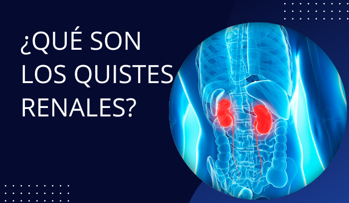 ¿Qué son los Quistes Renales? - Urólogo especialista en Málaga. Dr. J ...